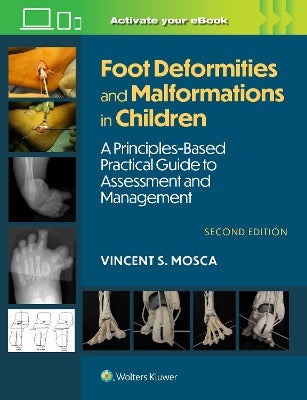 Foot Deformities and Malformations in Children by Vincent Mosca | Paper ...